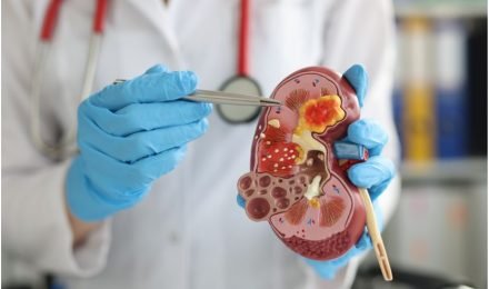 Tenho pedra nos rins: e agora? - Médico Urologista em SP